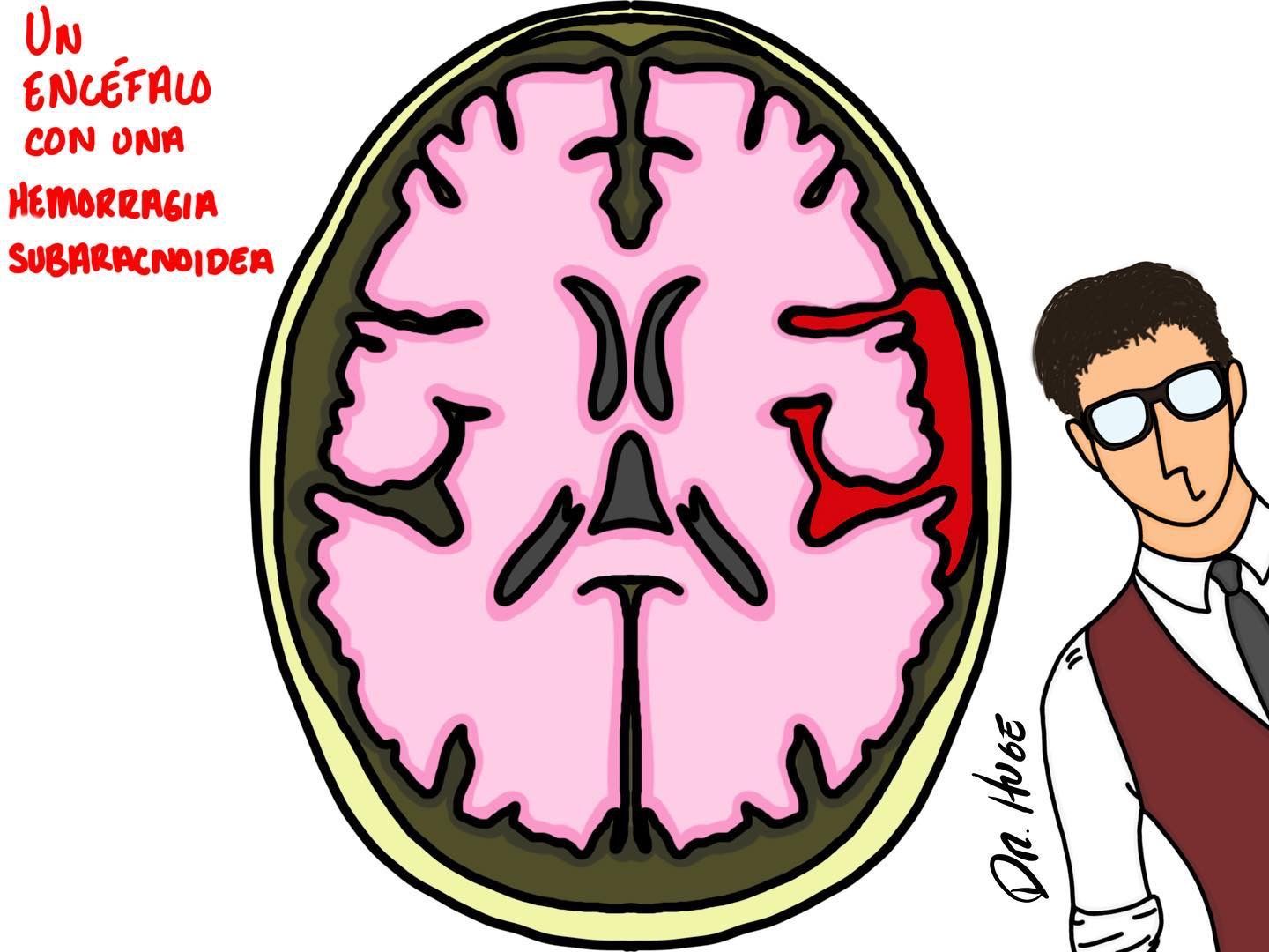 Hemorragia Subaracnoidea. Diagnóstico y Tratamiento - Tu medico informa