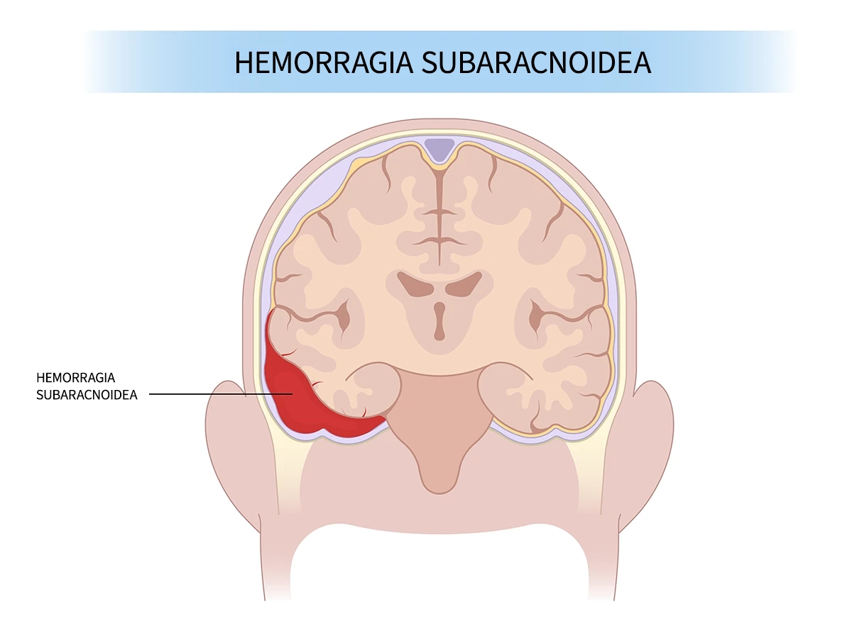 Hemorragia Subaracnoidea. Causas y Factores de Riesgo - Tu medico informa
